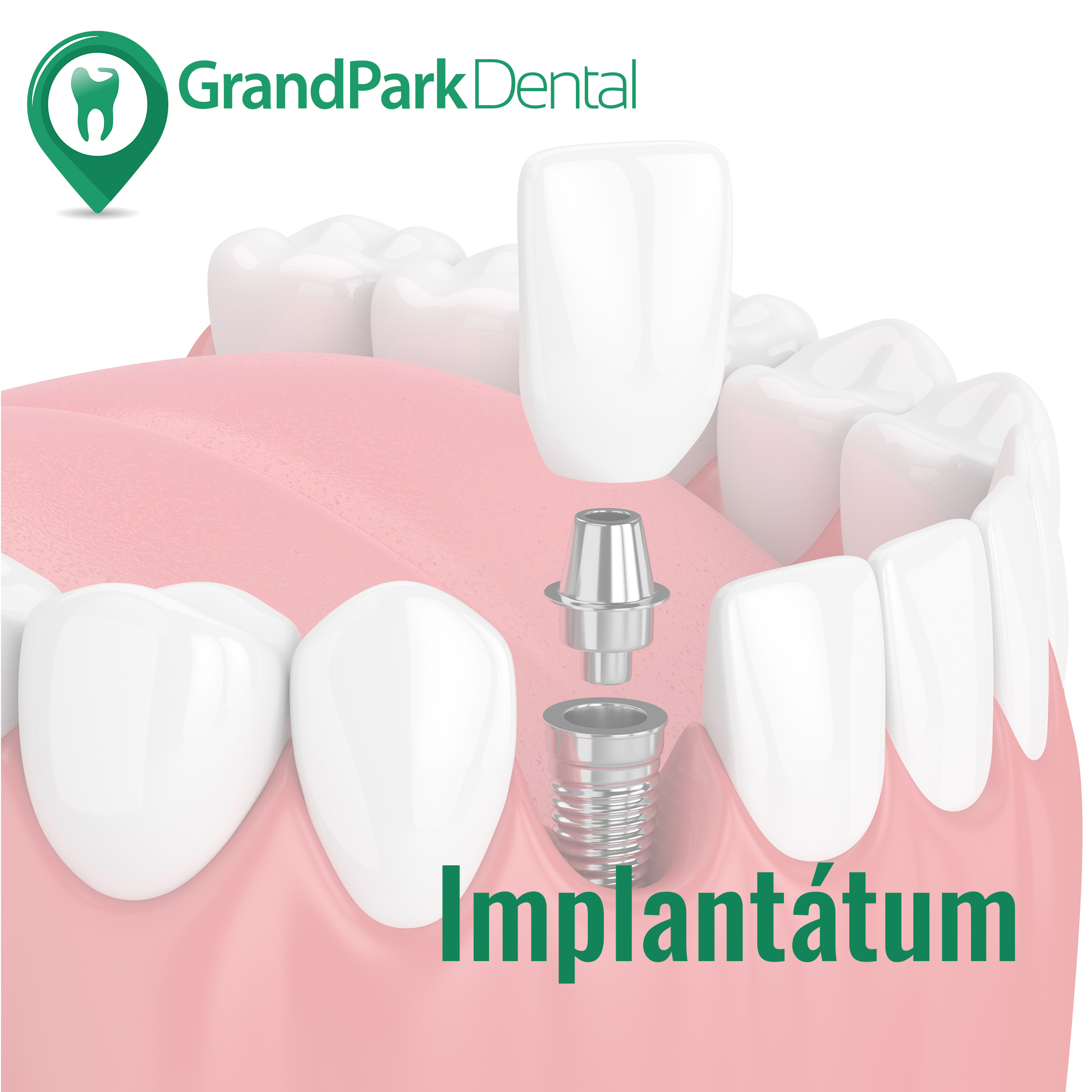 Implant is the most modern, most aesthetic, effective solution